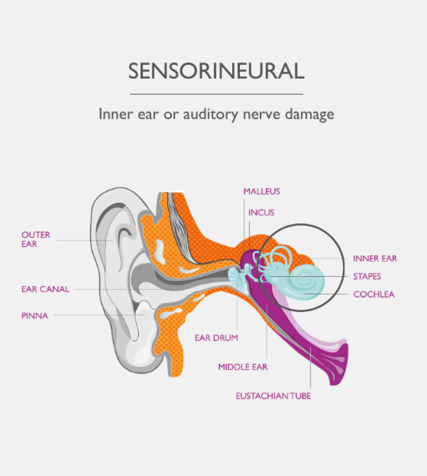 Hearing Loss Advice | Symptoms, Causes & Treatment | Leightons