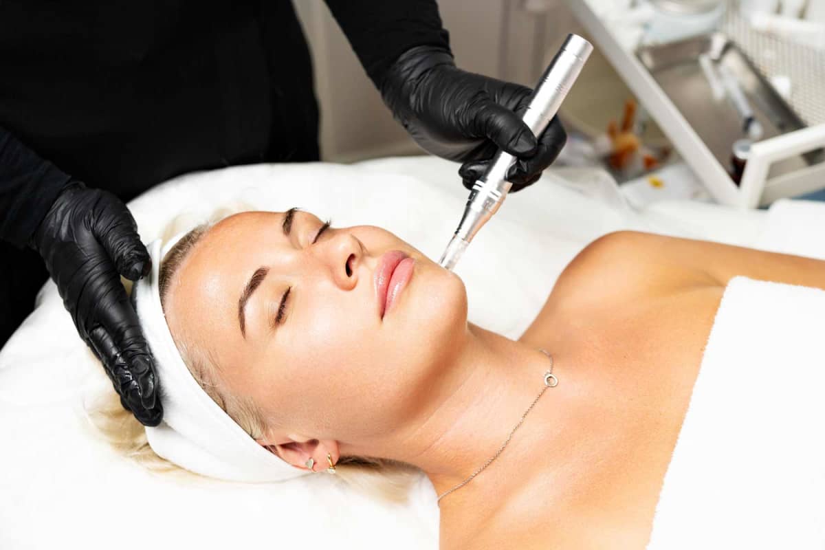 How Much Does Microneedling Cost? (2026)