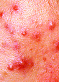 Qué Causa el Acné? - Genes y Nutrición