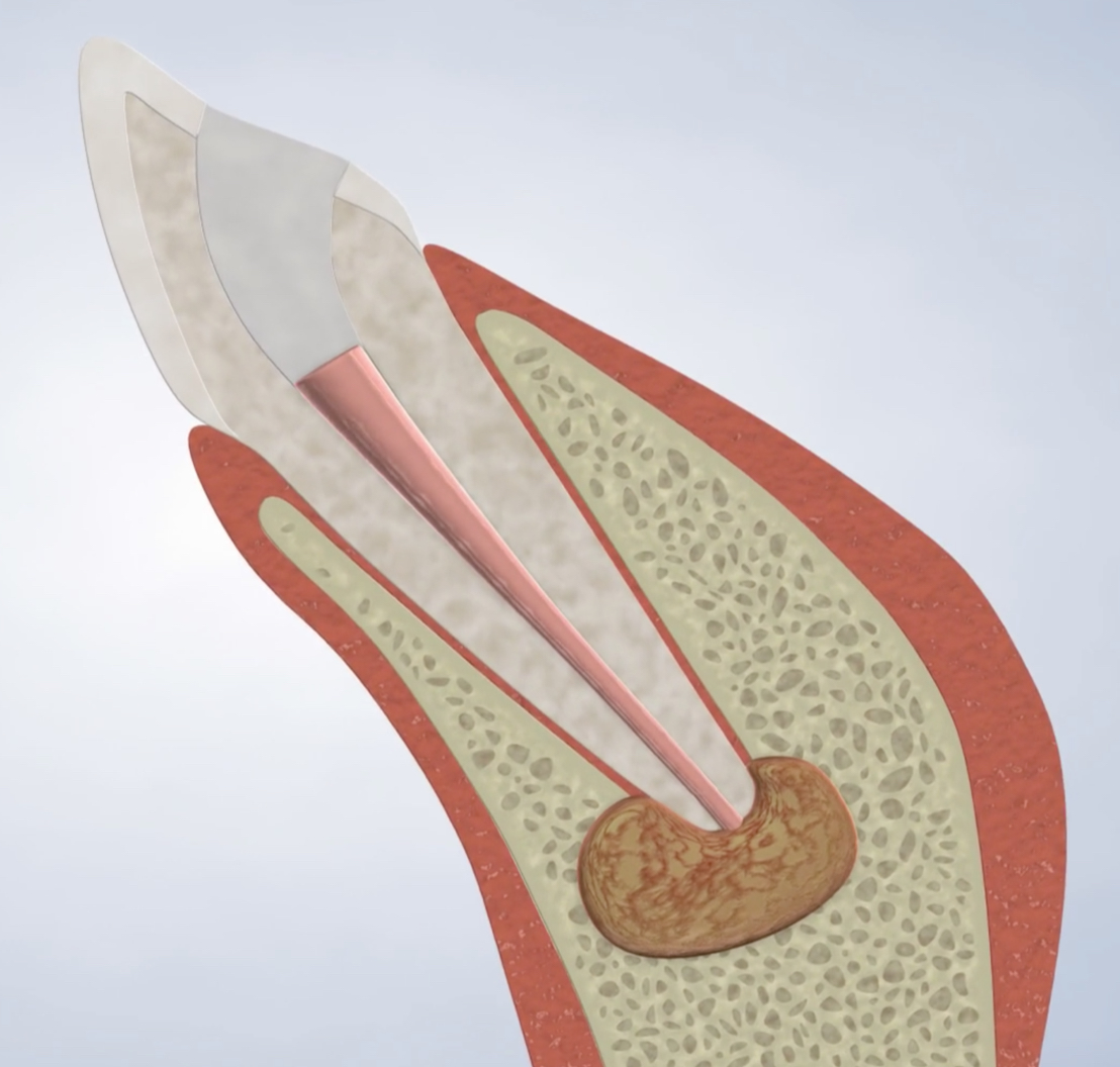 Apicoectomy in Norton Shores, MI | Breakwater Oral Maxillofacial ...