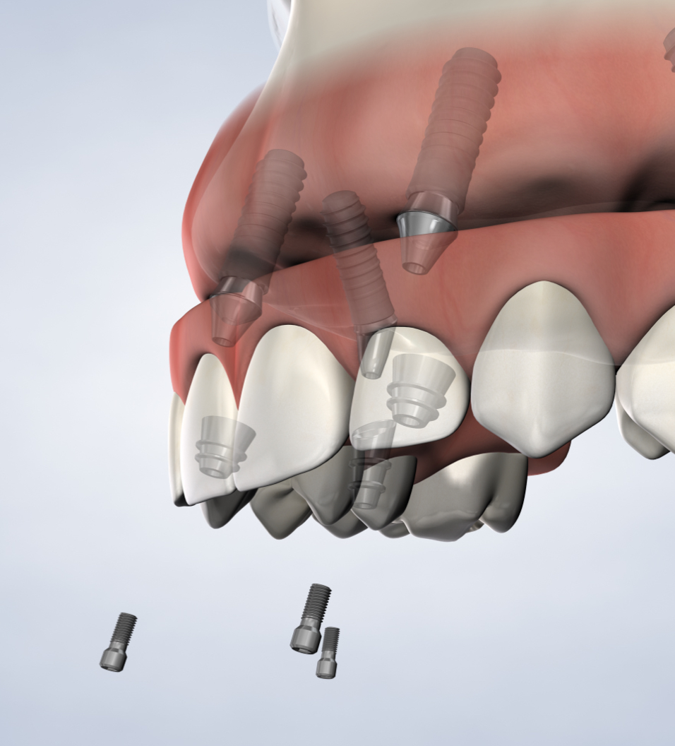 Same-Day Teeth in Feasterville, Newtown, and Abington, PA