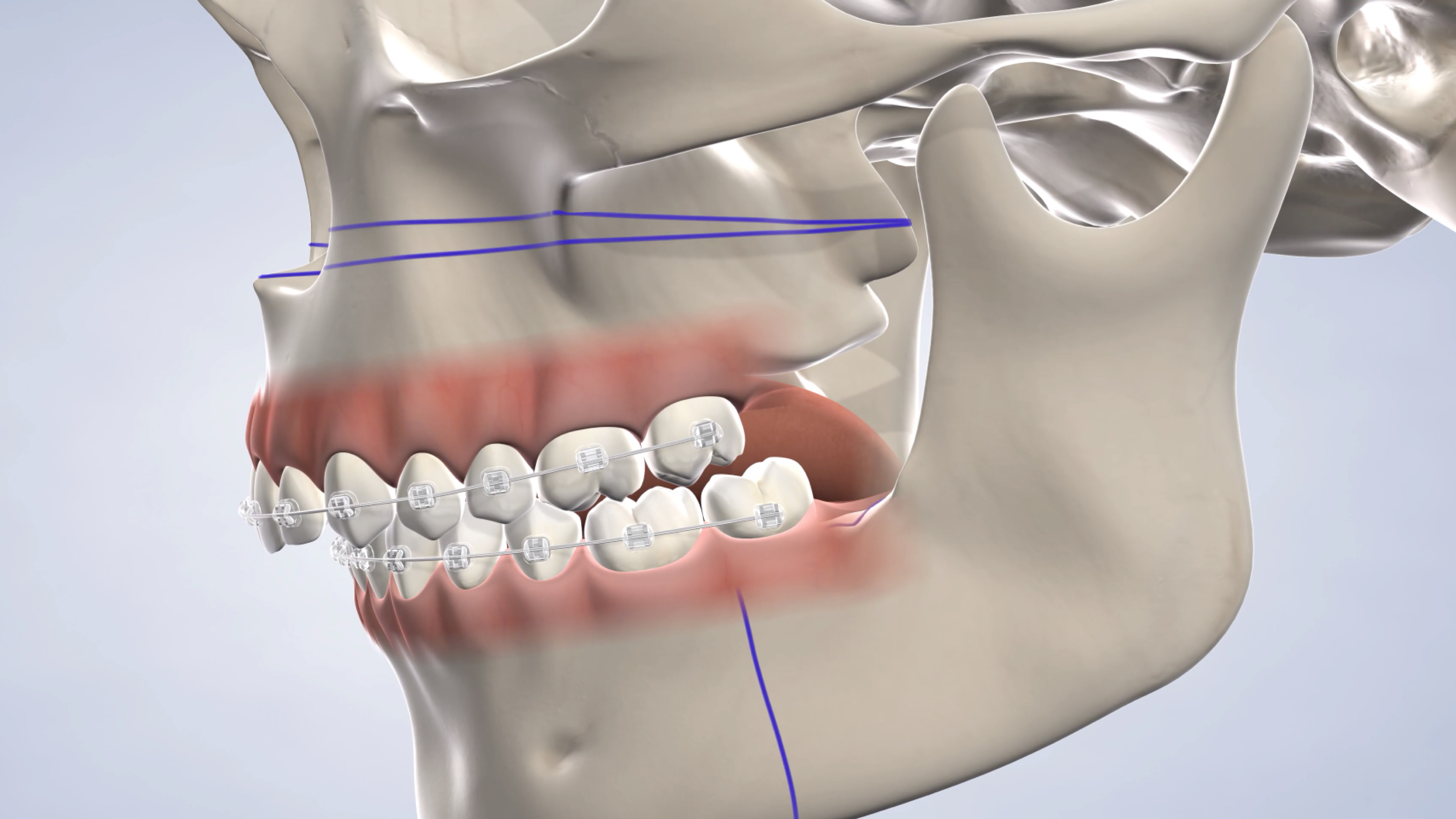 Jaw Surgery in Feasterville, Newtown, and Abington, PA