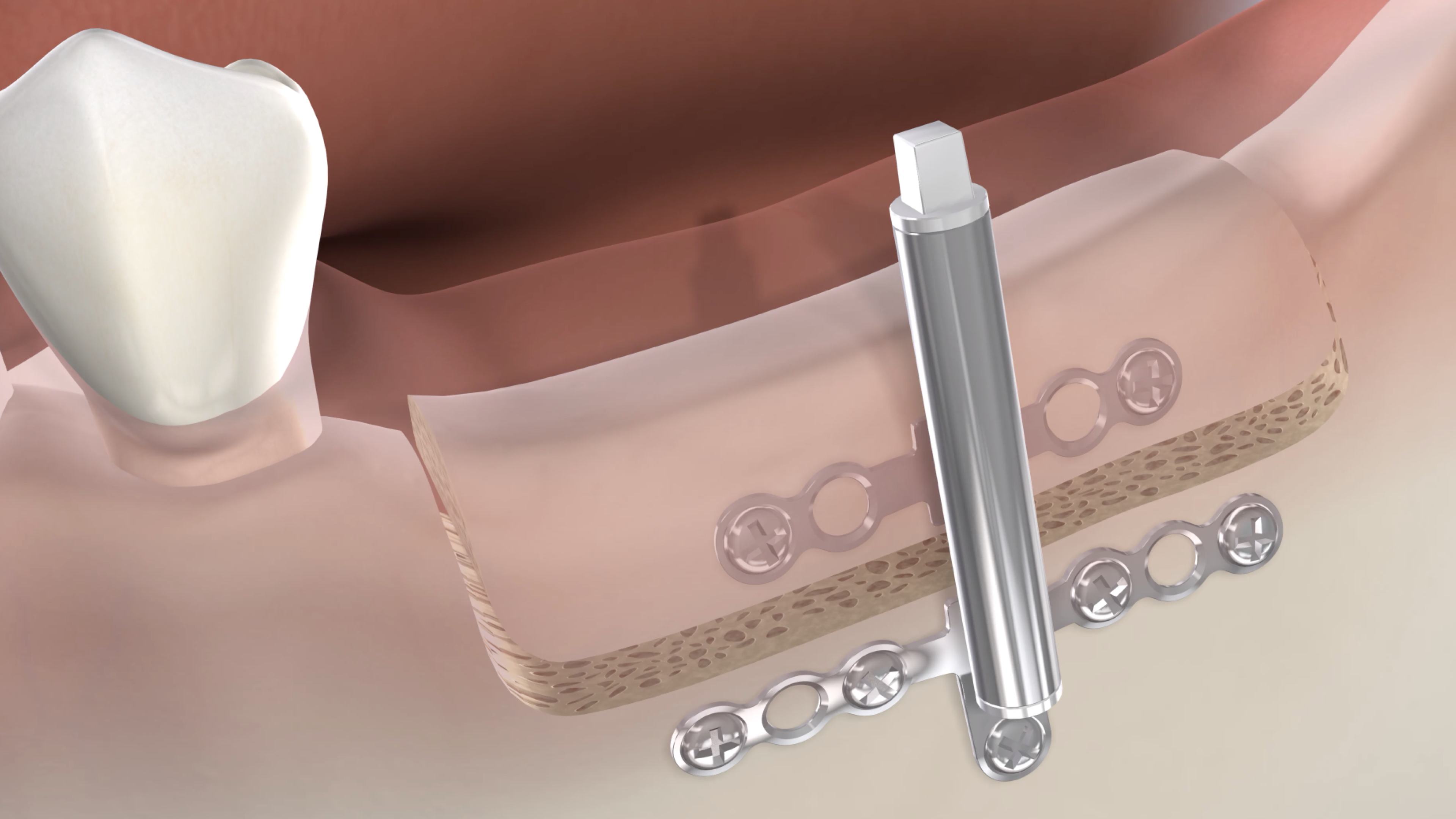 Distraction Osteogenesis in Feasterville, Newtown, and Abington, PA