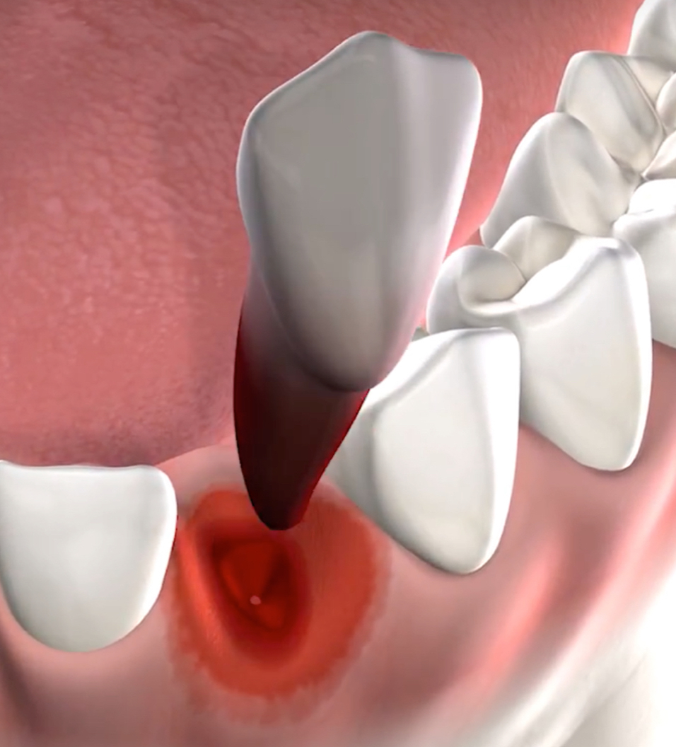 Procedures at Innovative Oral Surgery & Dental Implants