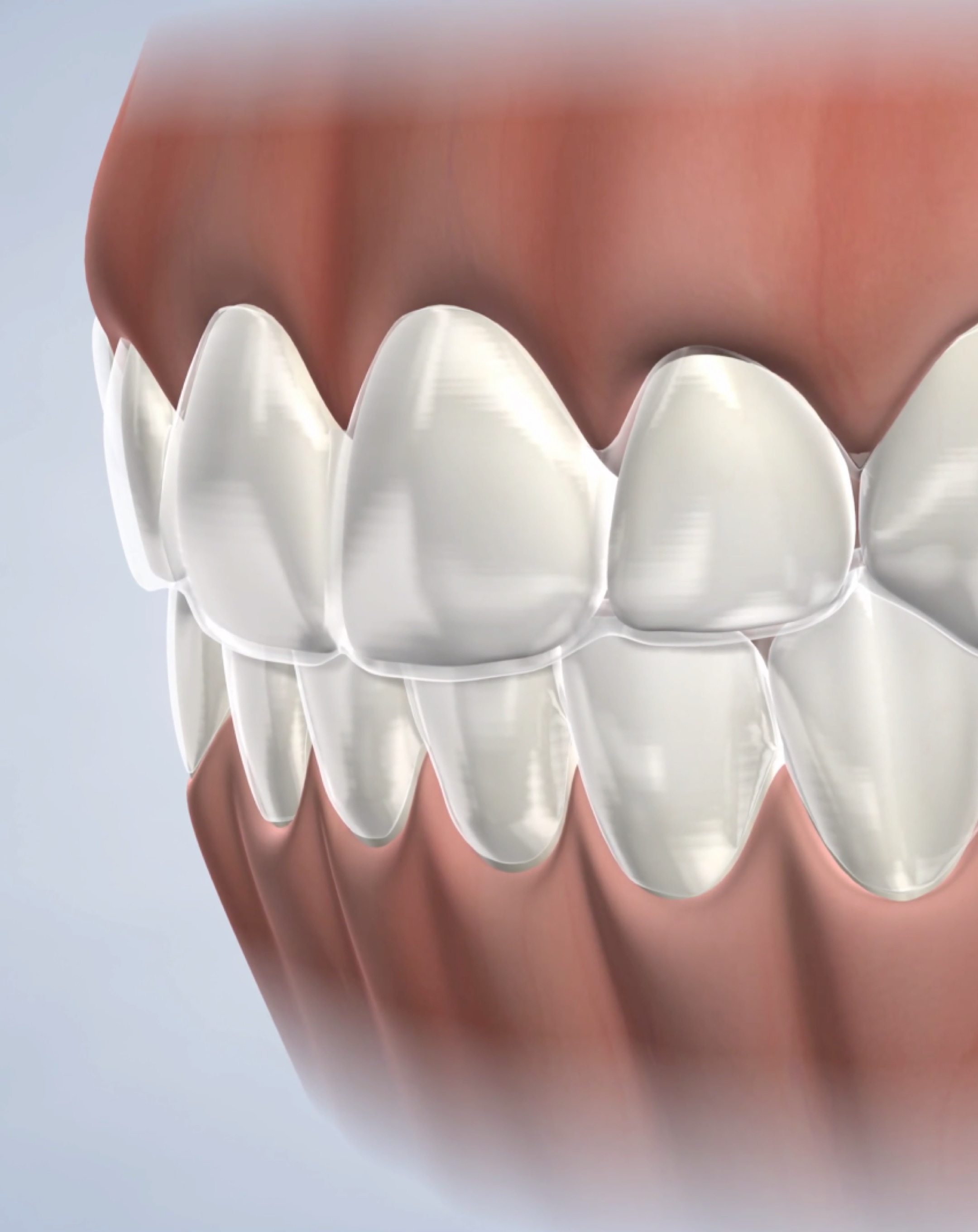 Fluoride Treatment in San Francisco, CA | Dentist in San Francisco