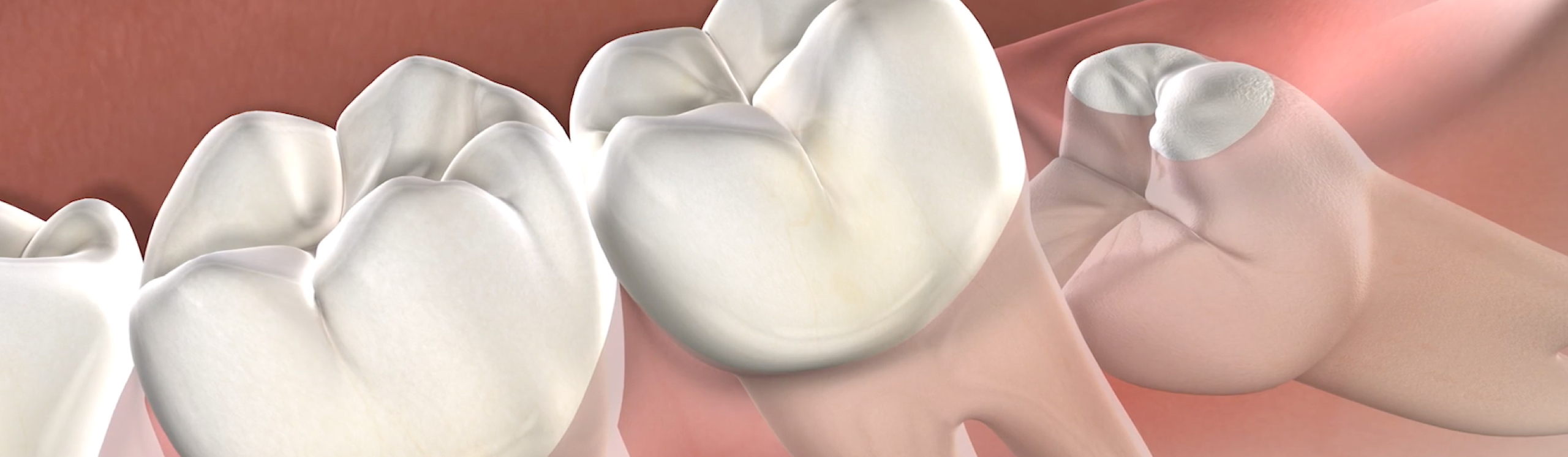 Wisdom Teeth Removal Procedure | Lifestyle