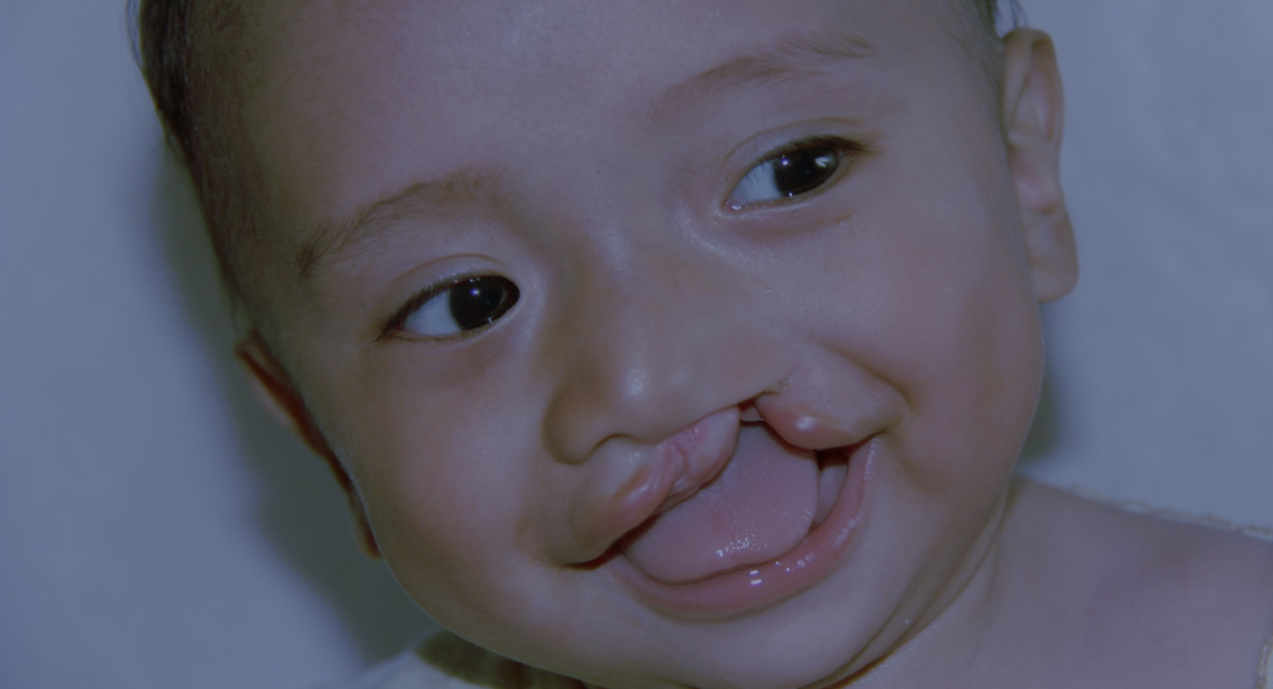 Cleft Care | Carolinas Center for Oral & Facial Surgery