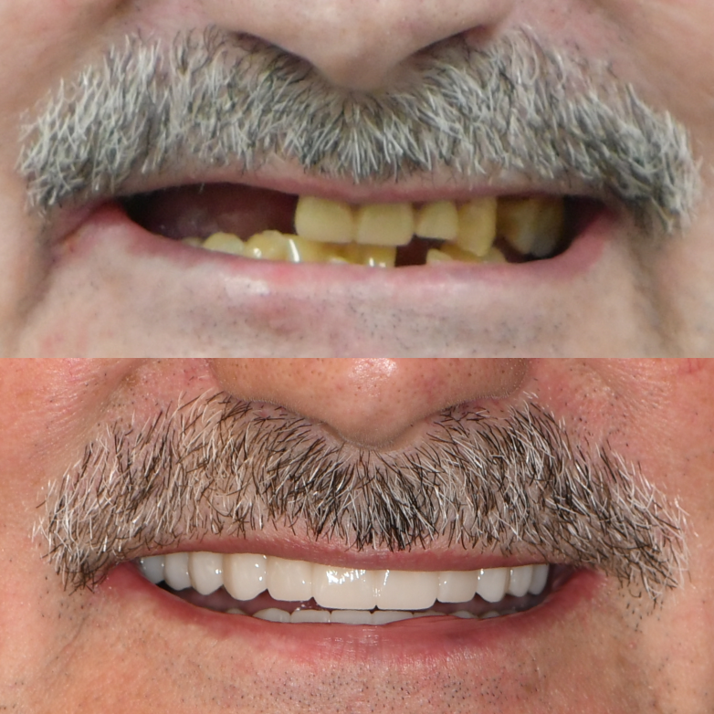 Full Arch Restoration in Watertown, NY | All-on-4 Treatment Concept