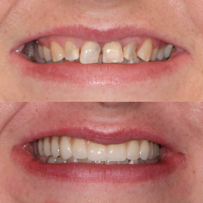 Full Arch Restoration in Watertown, NY | All-on-4 Treatment Concept
