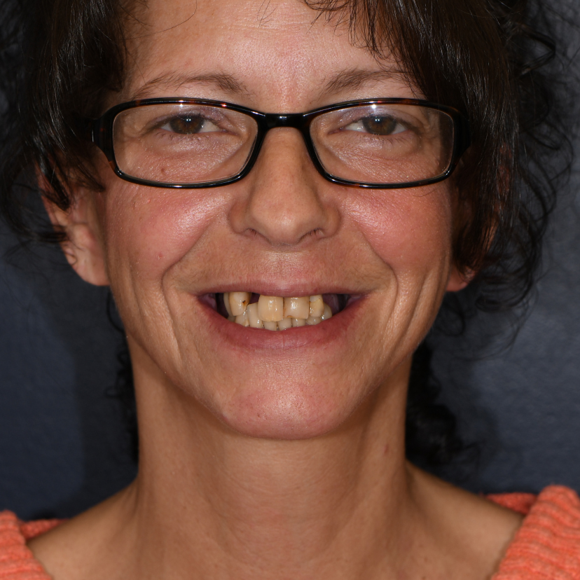 Full Arch Restoration in Watertown, NY | All-on-4 Treatment Concept