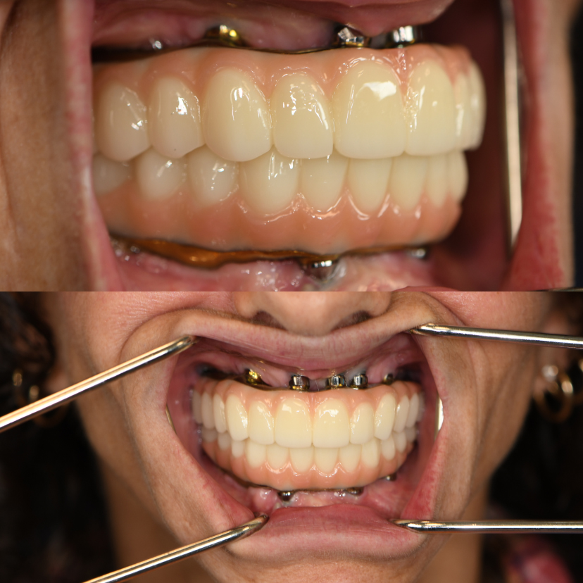Full Arch Restoration in Watertown, NY | All-on-4 Treatment Concept