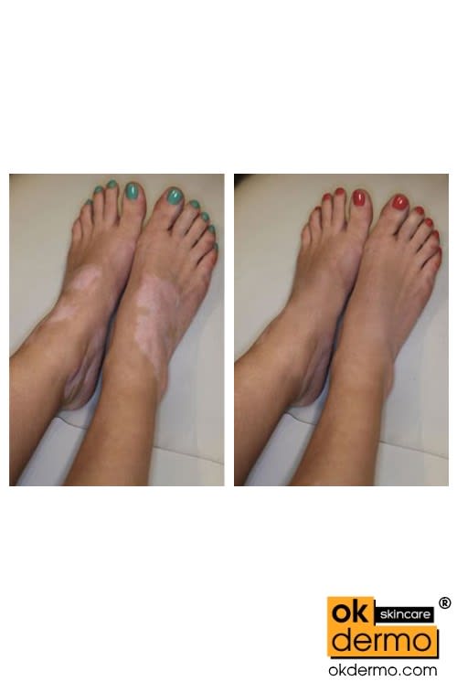 Benoquin® [20% Monobenzone Cream] Depigmenting Vitiligo Cream 20g ...