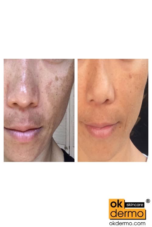 [Hydroquinone 4% USP] Melalite Forte® Skin Lightening Cream 30g | OKDERMO®