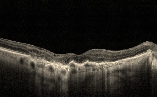 Questions fréquentes : DMLA - Dr Patrick Loriaut - Chirurgien ...