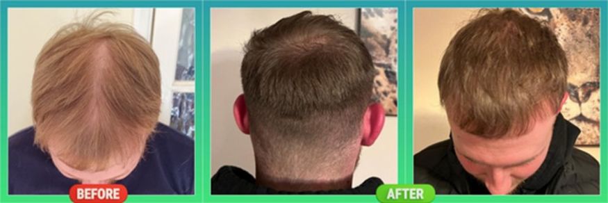 ED’s Hair Loss Treatment Journey 6 Month Update
