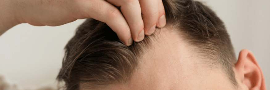 How to tell if you have male pattern baldness