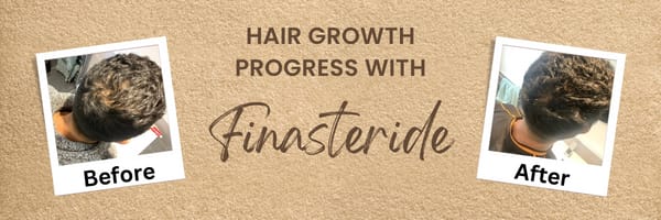 Finasteride: Before and After Images