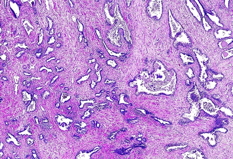 TRexit The Movement To Leave Traditional Prostate Biopsy Behind Prostate Cancer Foundation trexit-the-movement-to-leave-traditional-prostate-biopsy-behind-prostate-cancer-foundation