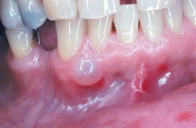 Histologia Do Cisto Periodontal Lateral BJORL Brazilian Journal Of