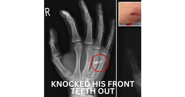 Knocked His Front Teeth Out - Proper True Yarn | Acast