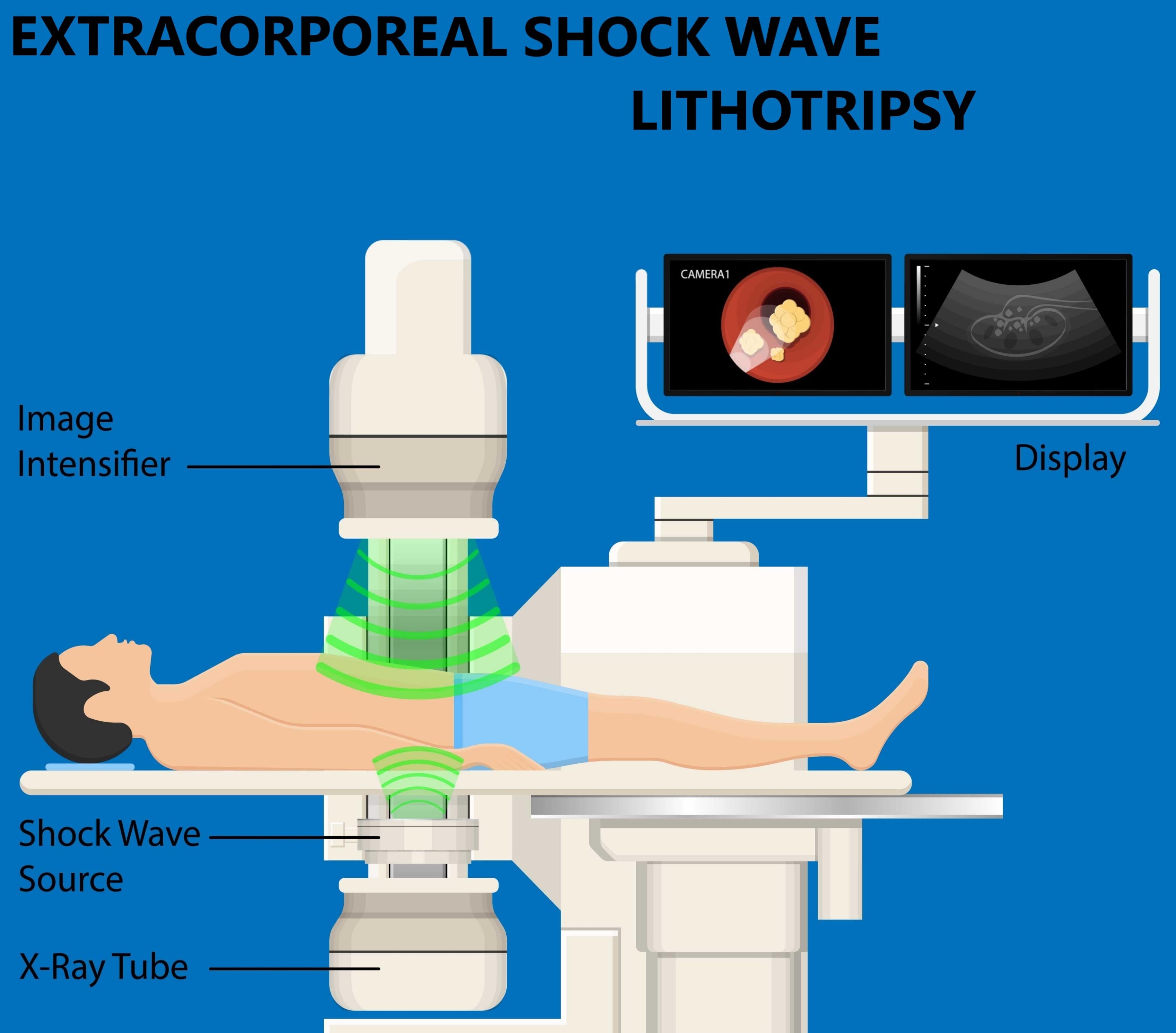 Extracorporeal Shock Wave Lithotripsy For Gallstones