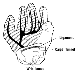 Carpal Tunnel Syndrome: Penyebab, Gejala & Pencegahan