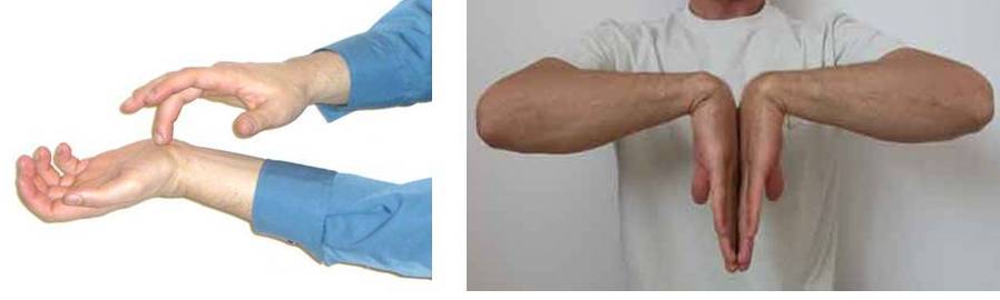 Carpal Tunnel Syndrome (Sindroma Terowongan Karpal) - Prodia OHI