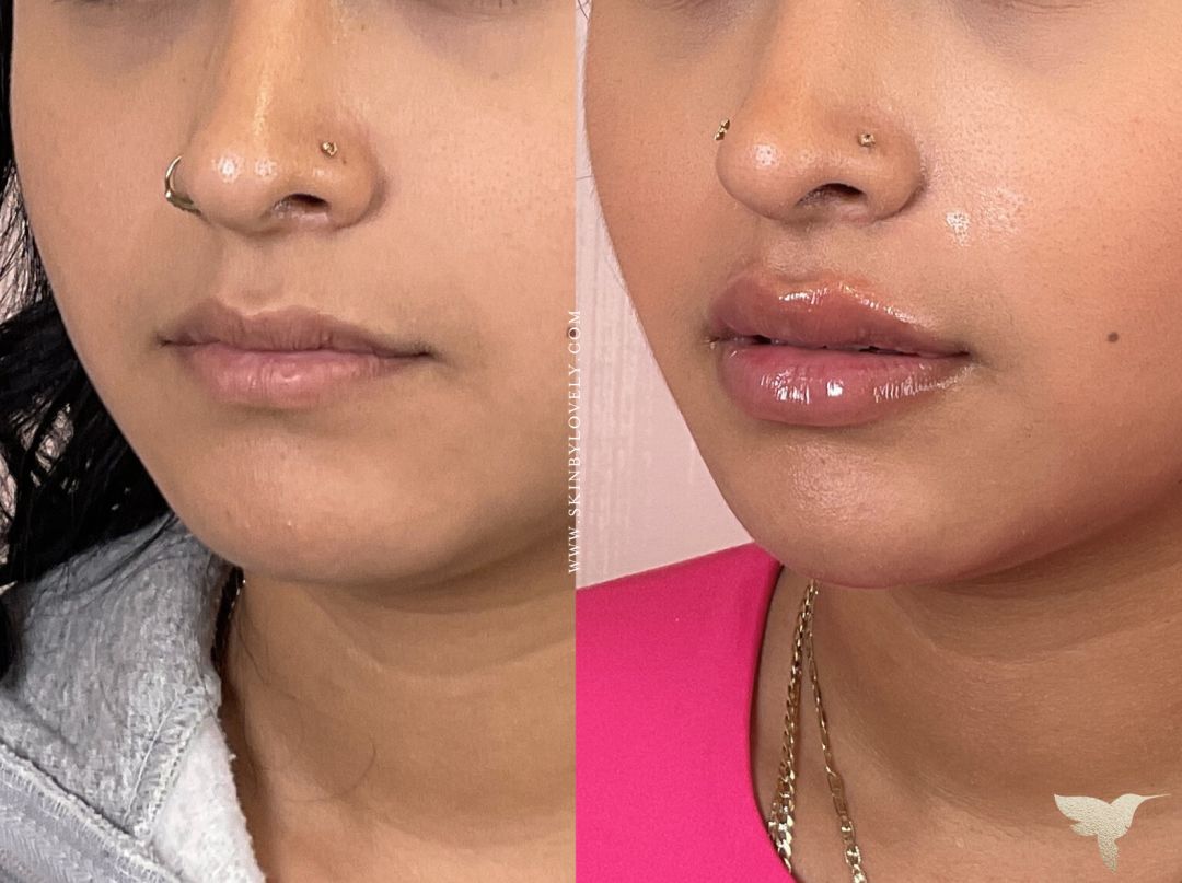 Lip Fillers: Discover the Perfect Pout with Skin by Lovely’s Expertise ...