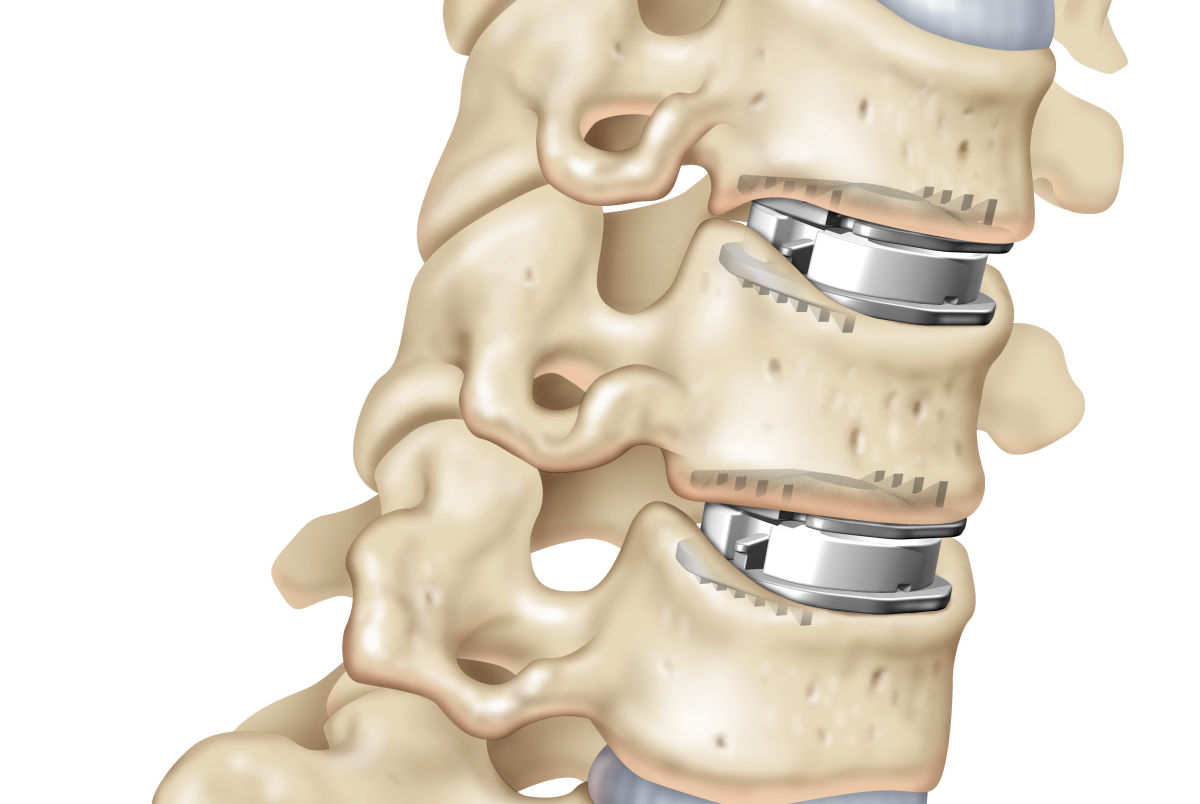 Mobi-C Cervical Disc | Houstonia Magazine