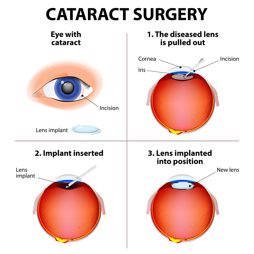 New Cataract Lens Technology Offered At Sarasota Practice Sarasota