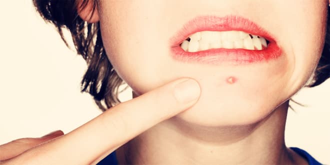 How to Stop Worrying About Pimples - Salmaniac