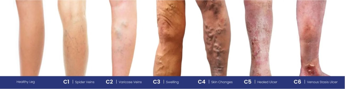 Stages of Vein Disease: What You Need to Know