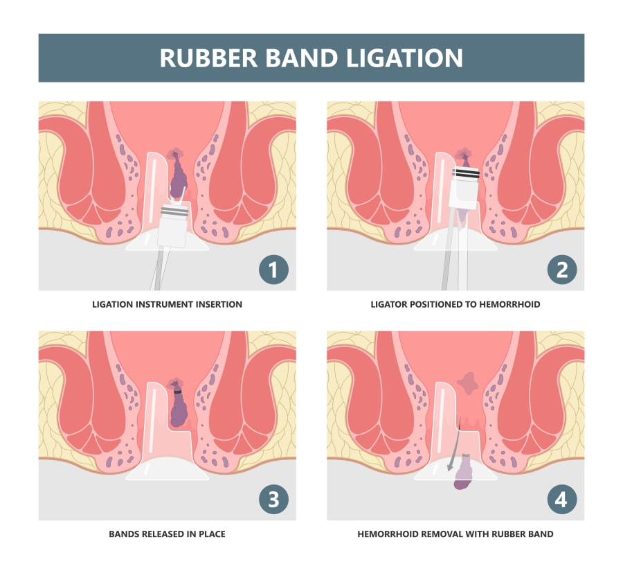 Hemorrhoid Treatment Guide: What to Expect from Rubber Band Ligation ...