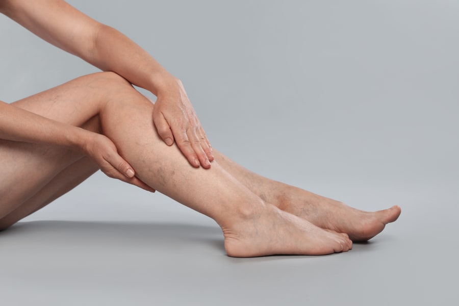 Stages of Vein Disease: What You Need to Know