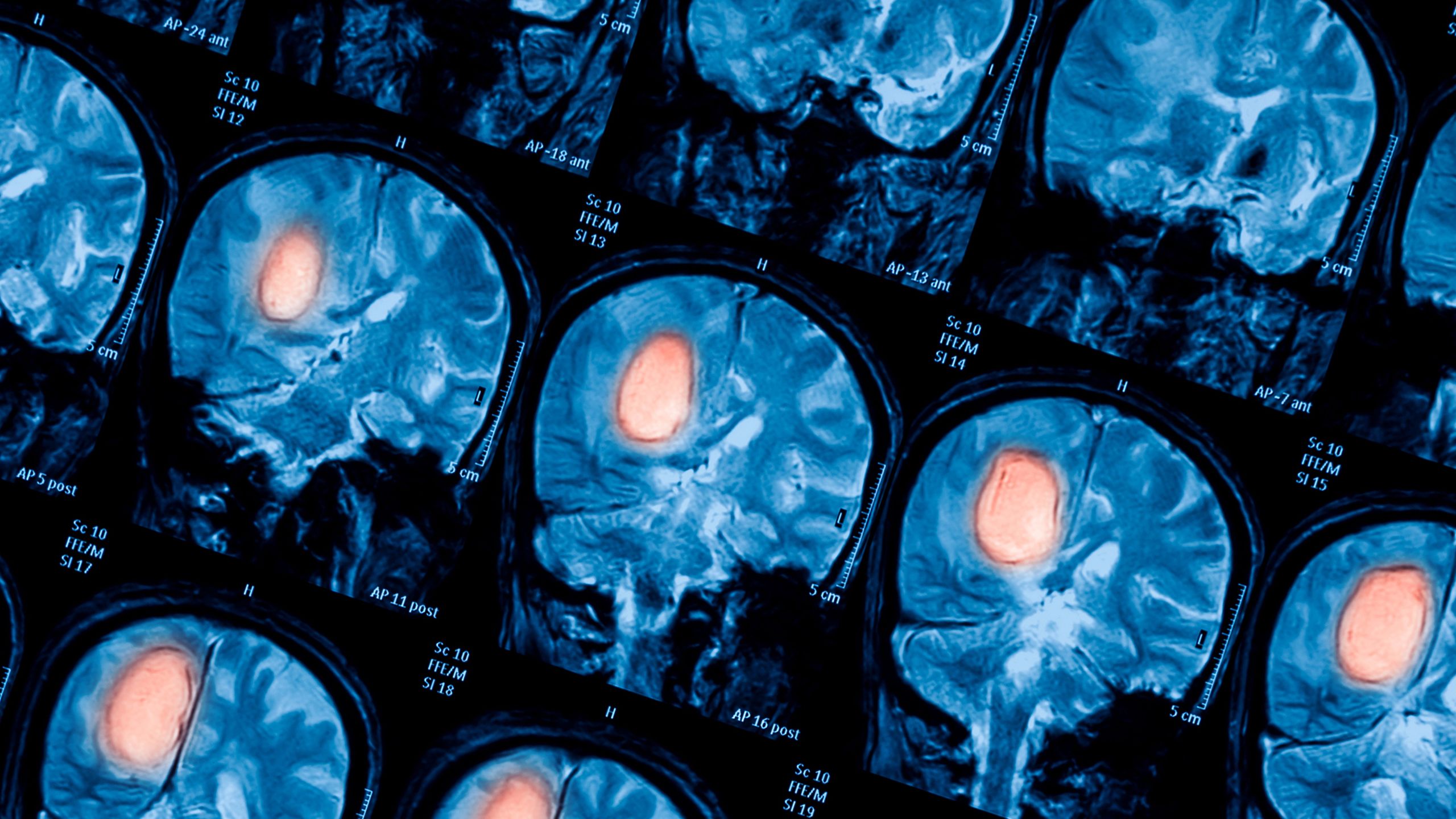 Brain Scan Depression