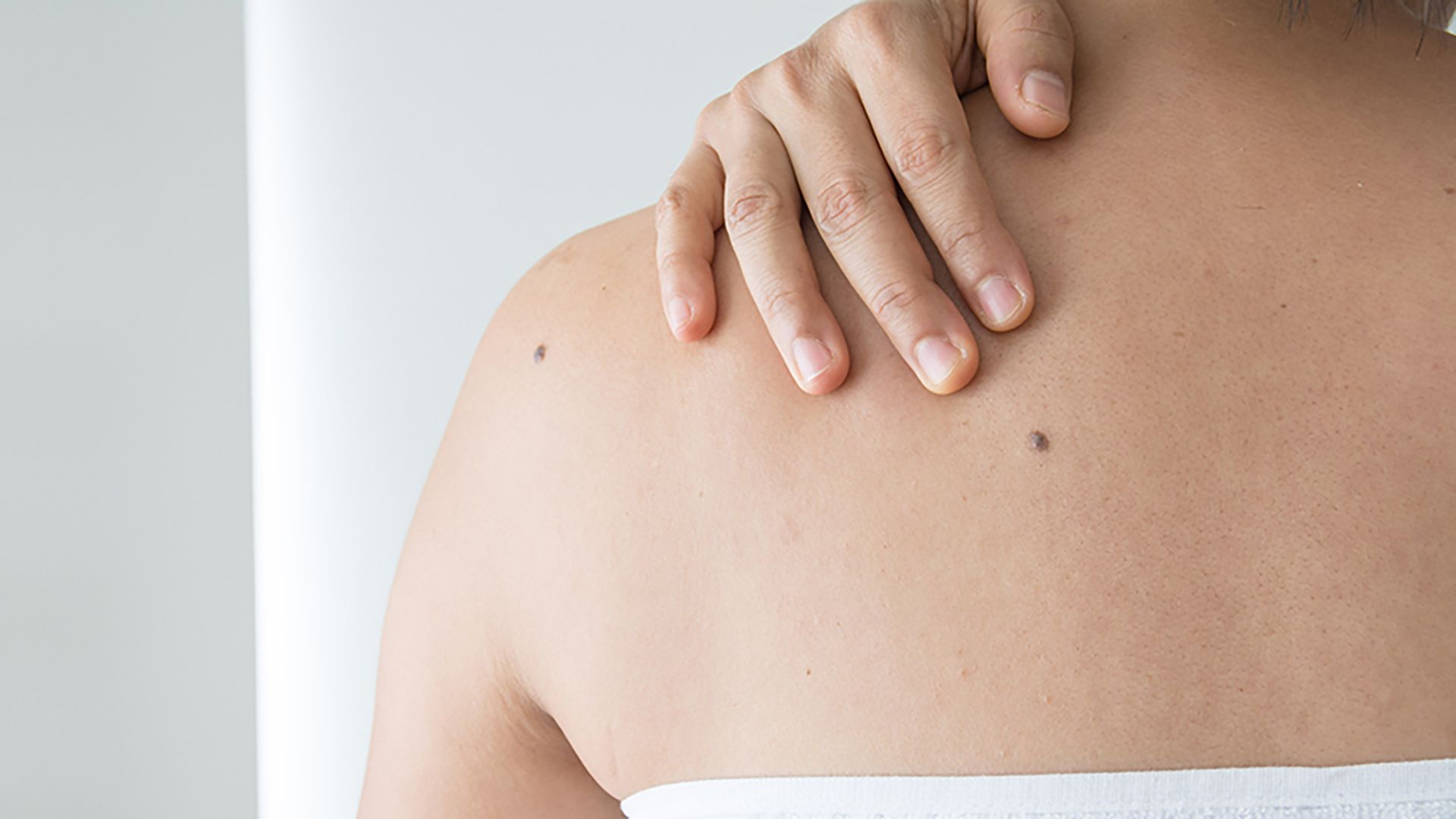 A Patient’s Guide to Advanced Basal Cell Carcinoma