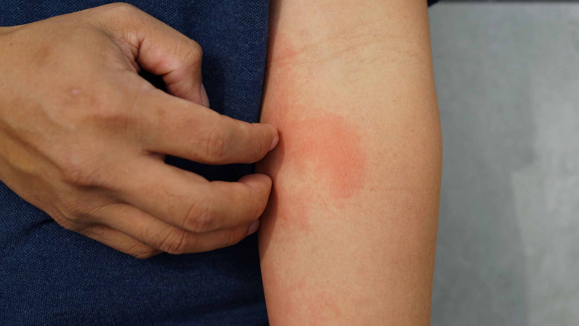 5 Tips for Coping with Atopic Dermatitis Itch - Sharecare