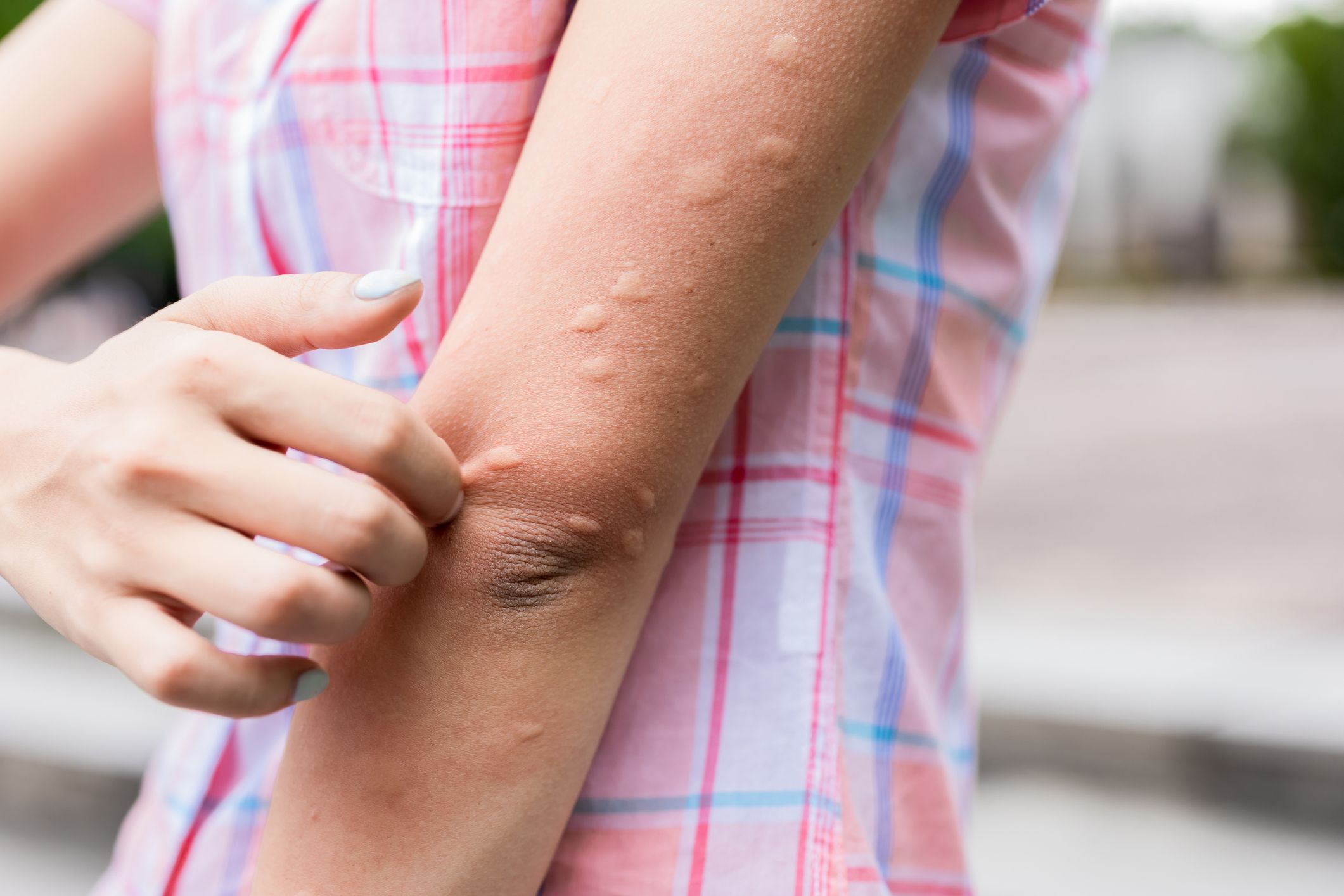 Understanding Chronic Hives - Sharecare