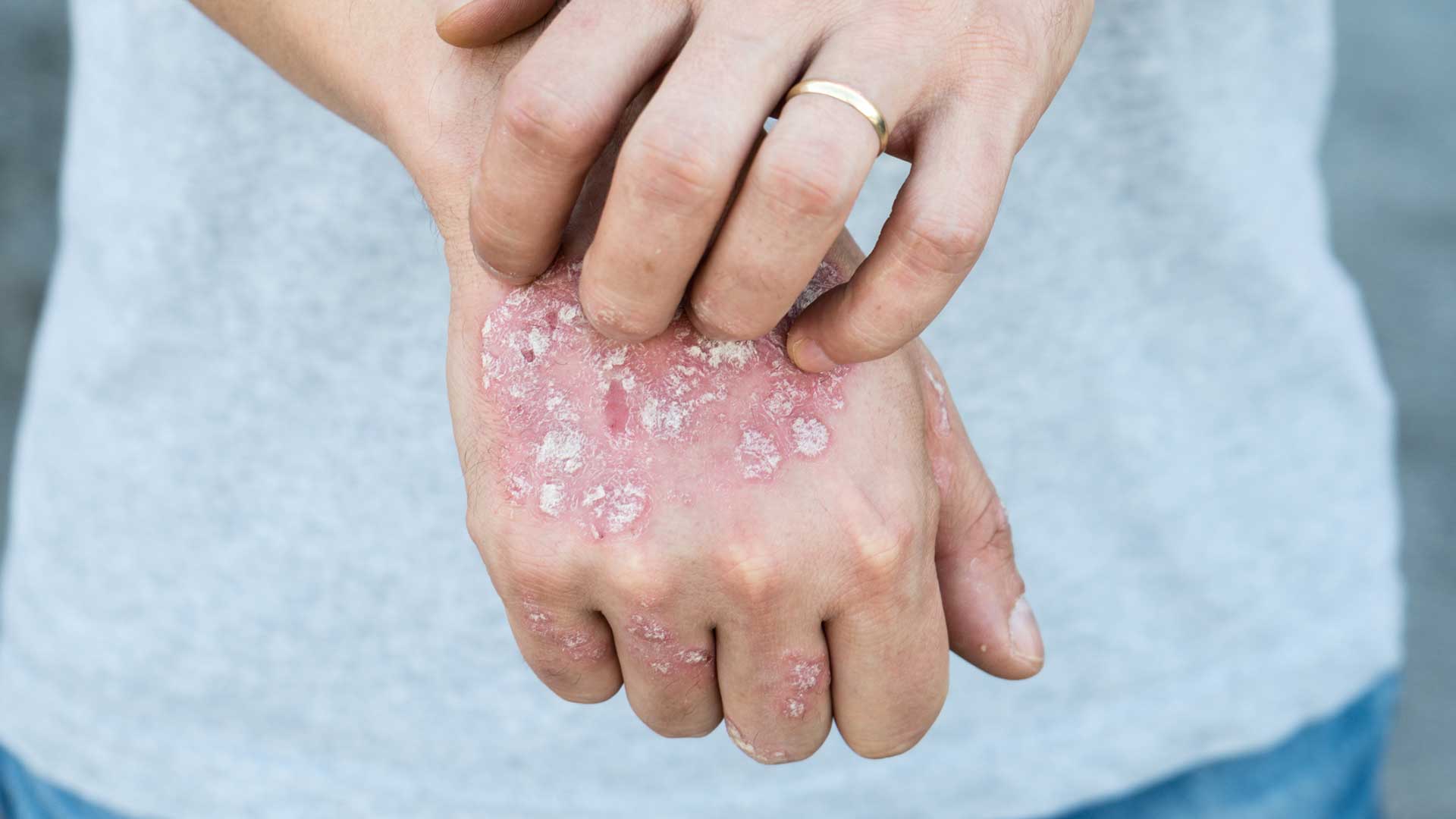 Psoriasis: Symptoms, Causes, Types & Treatment - Sharecare
