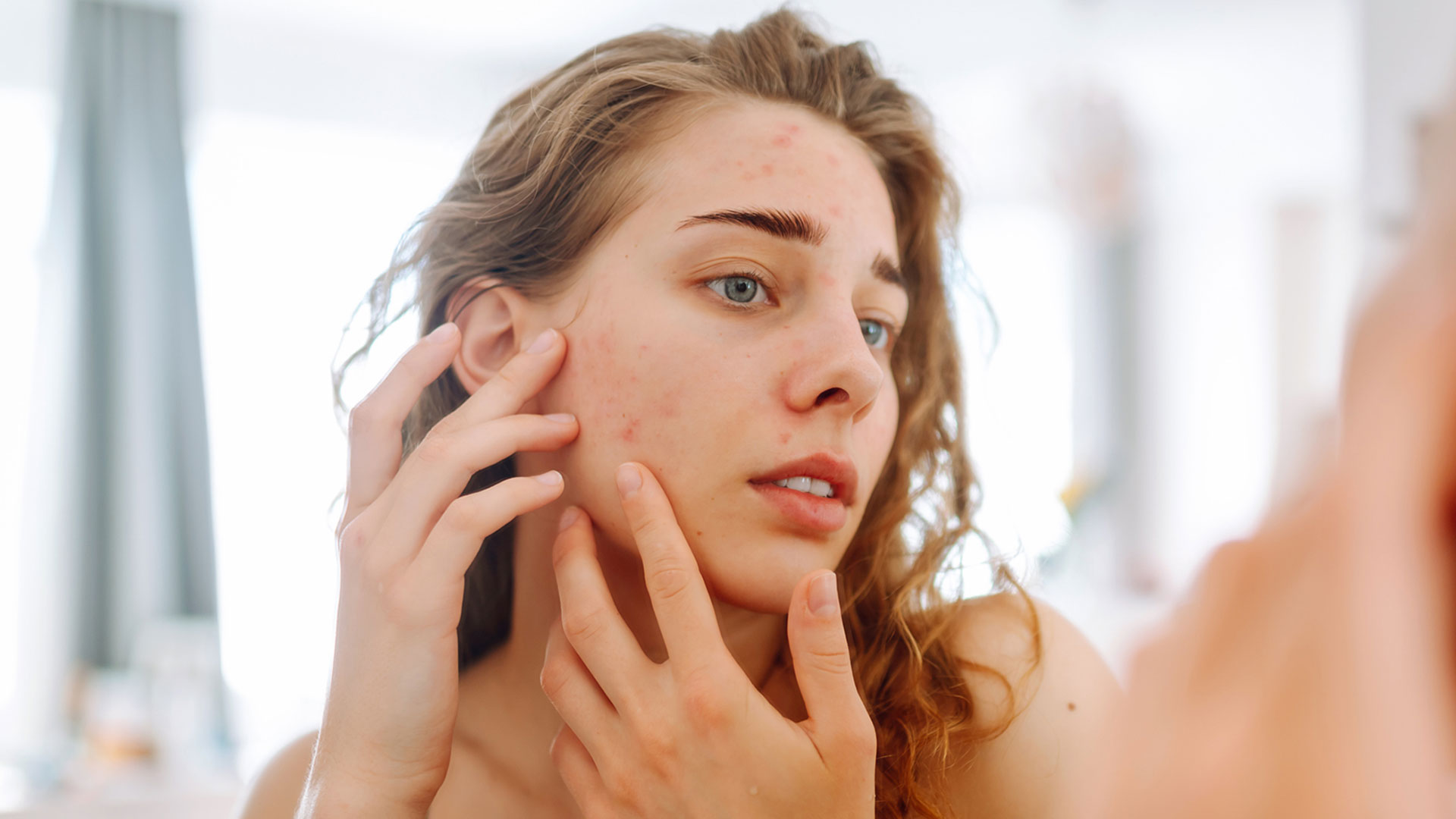 Acne: Types, Causes, Risk Factors, Treatment & More - Sharecare
