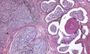 How accurate is a digital rectal exam? | Prostate Cancer - Sharecare