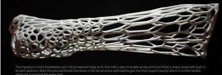 New Zealander's 3D printed design could do away with smelly casts ...