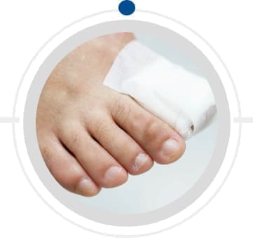 Minor Toenail Surgery | South Down Foot Clinic