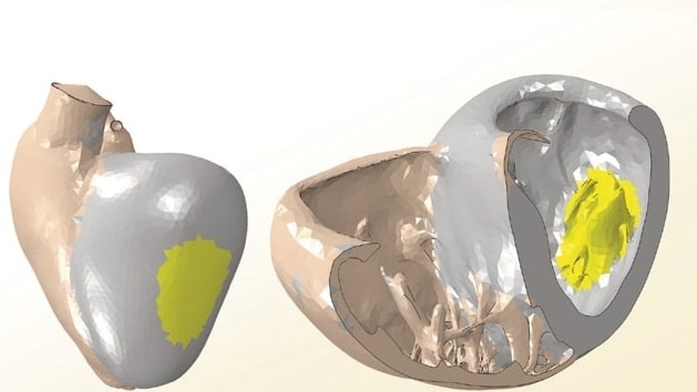Electric Mesh Device “Hugs” Heart, Improving Cardiac Function - Medical ...
