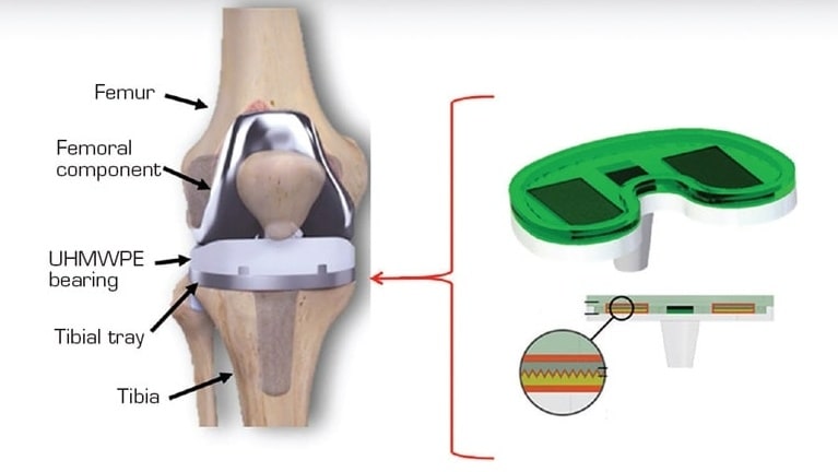 Hydraulic Prosthetic Knee Joints Provide More Natural Mobility for ...