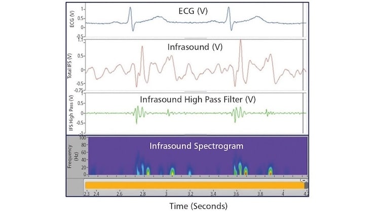 Developing an Analog Front-End for an Electrocardiogram Monitor ...