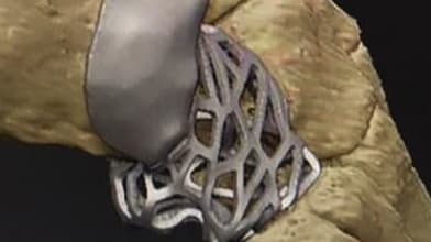 Additive Manufacturing: Creating the Next Generation of Orthopedic ...