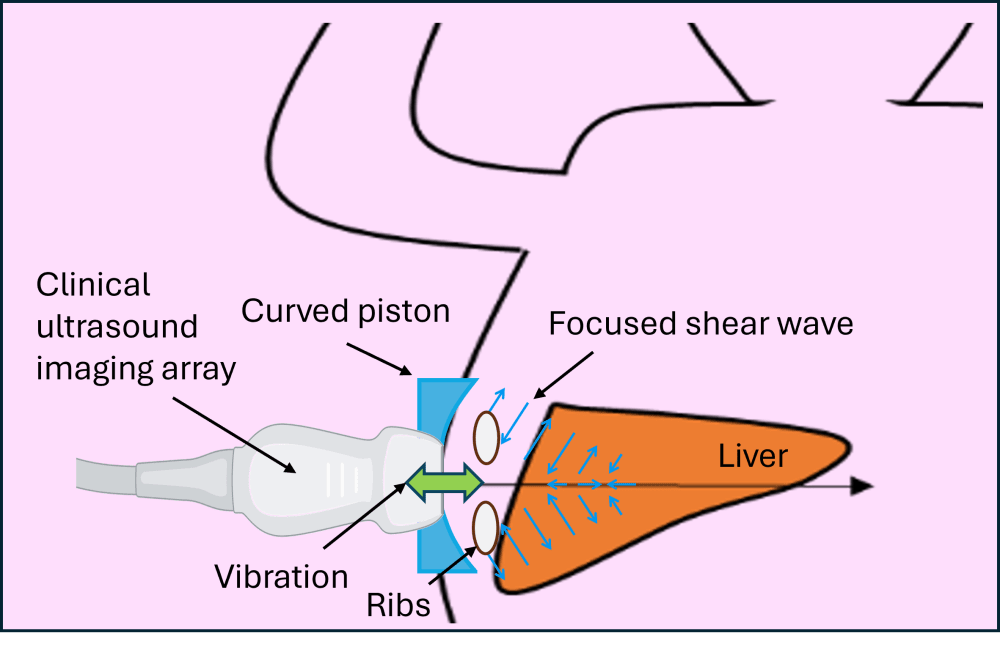 Enhanced Noninvasive Liver Fibrosis Assessment with a Novel Shear Wave ...