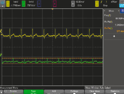 sine waveform ecg