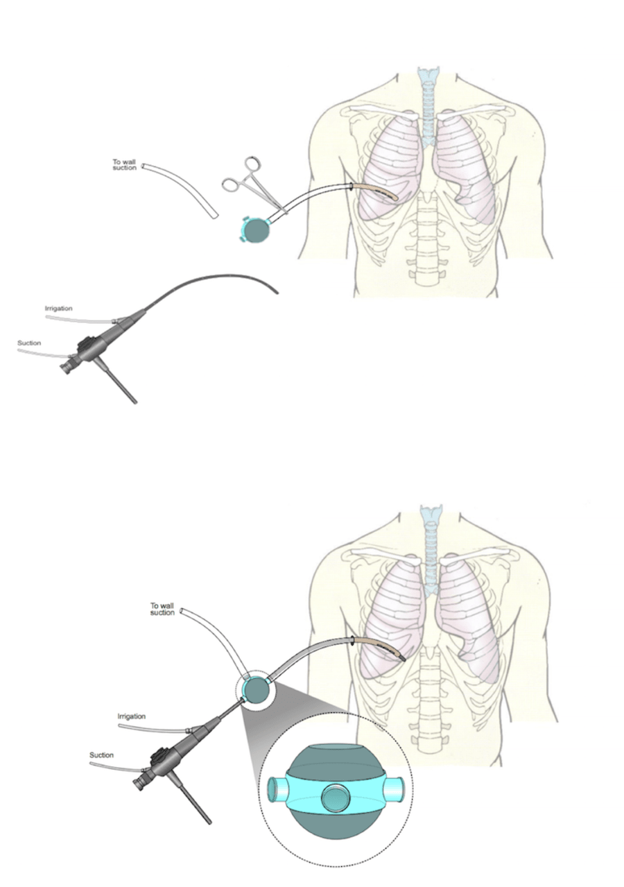 Novel Chest Tube Design To Alleviate Clogging And Facilitate Video ...